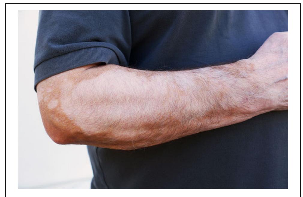 Kinky-hair syndrome associated with menkes disease photo