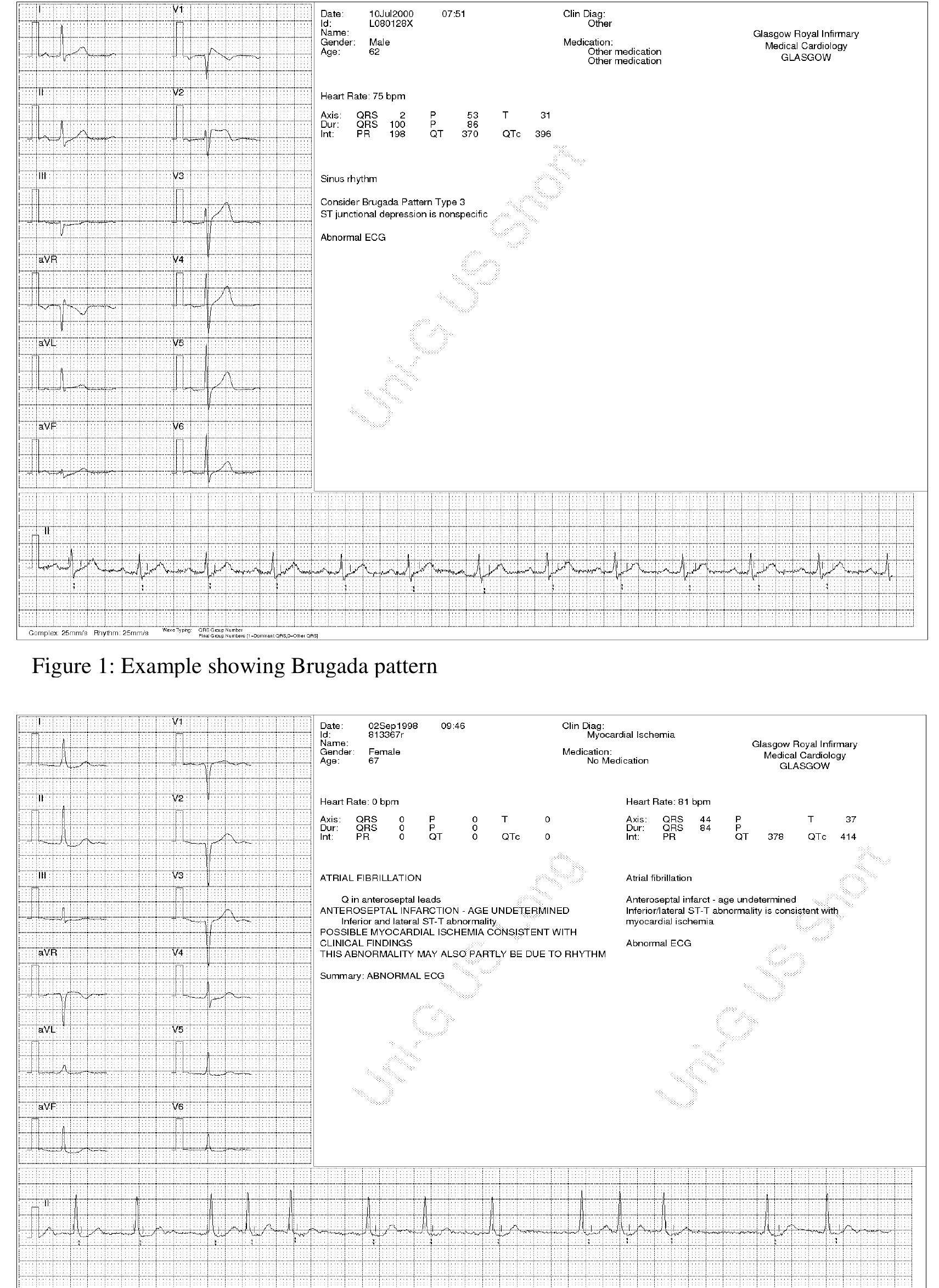 Figure 2 - The university of glasgow (Uni-G) ECG analysis