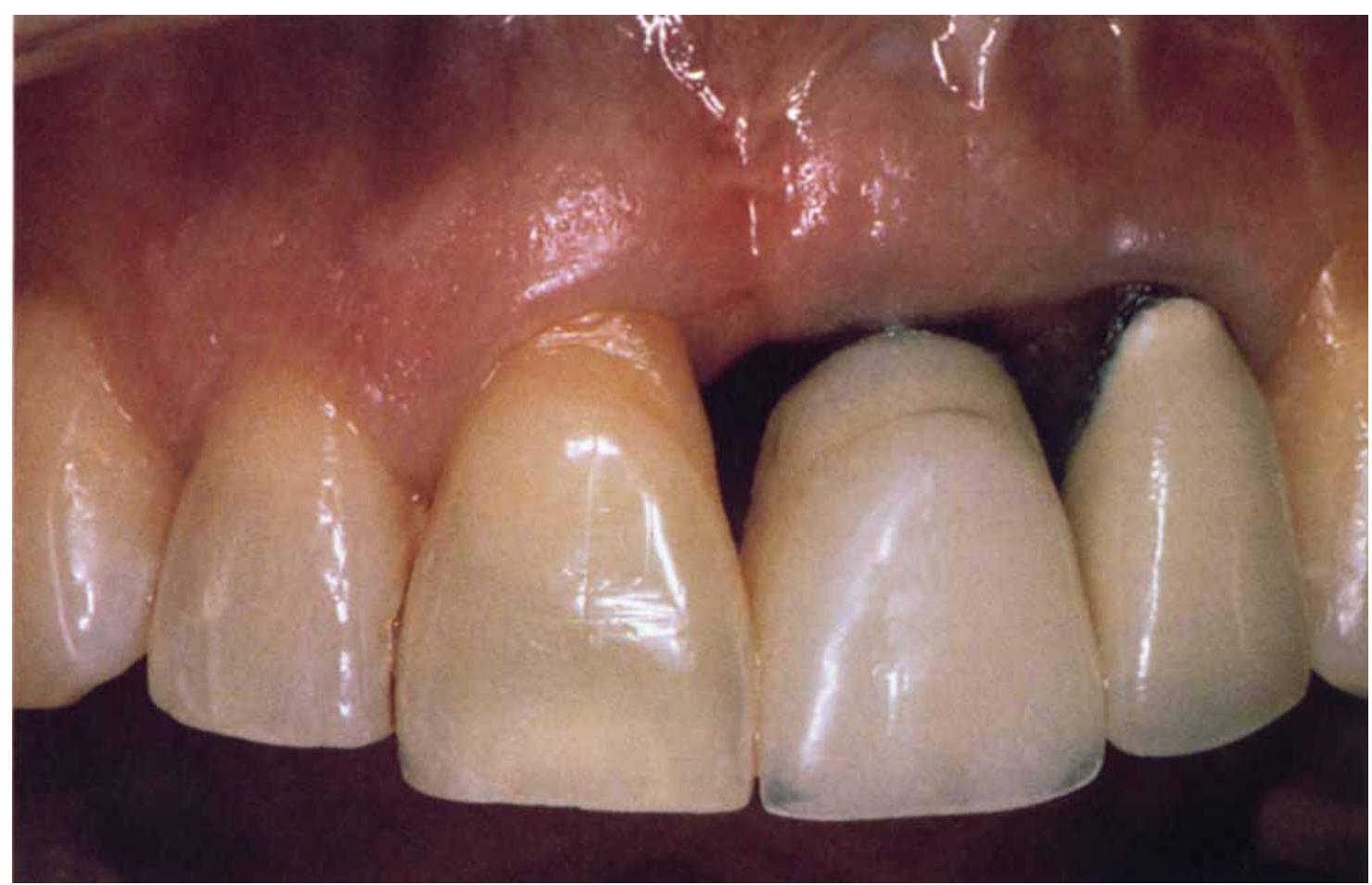 Maxillary left central incisor with a single-tooth