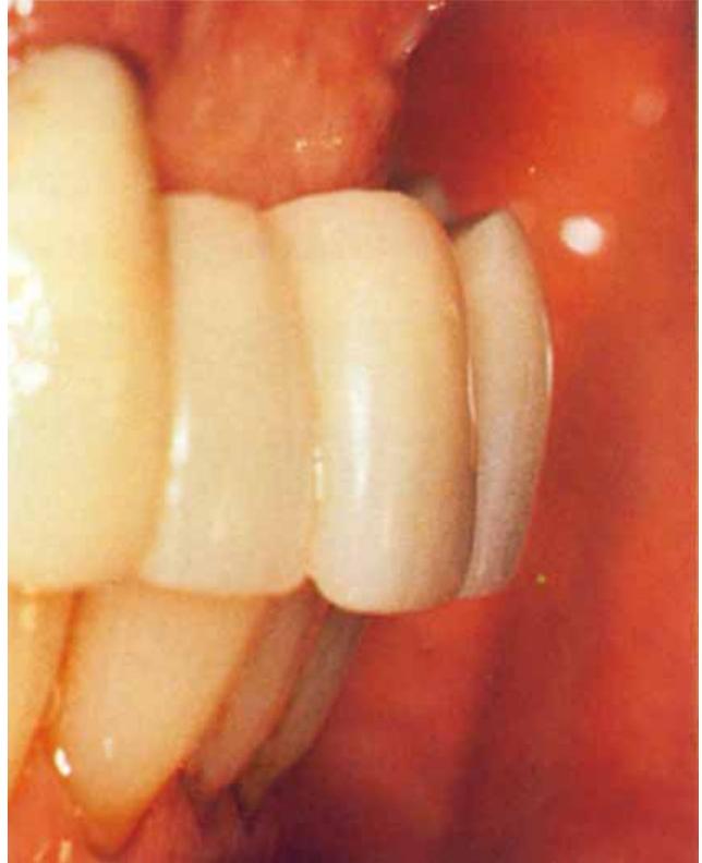 Lateral view of the same patient showing a large soft tissue
