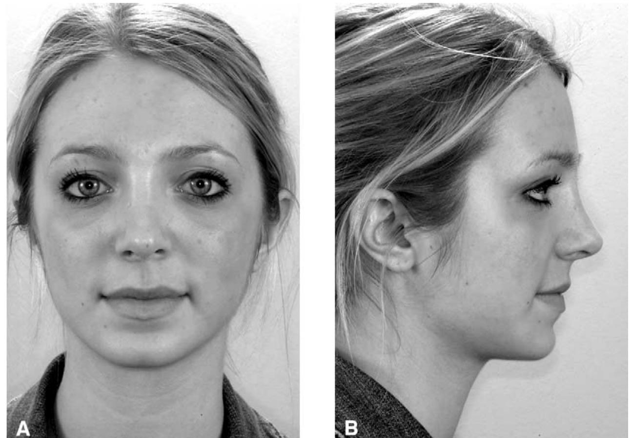 A, girl at age 16. nasal tip was surgically narrowed and