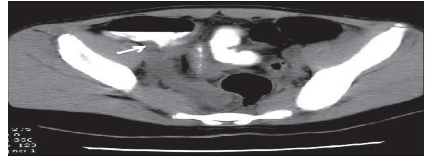 Ct scan shows an abnormal appendix