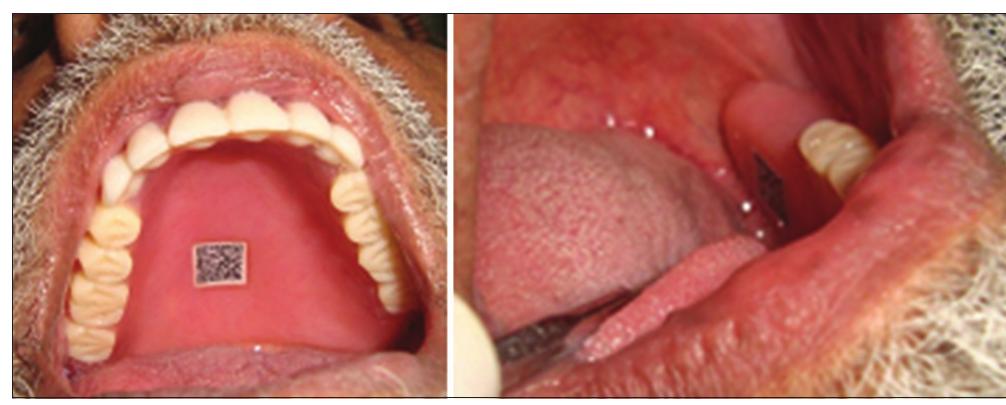 Maxillary and mandibular labelled dentures in patient’s