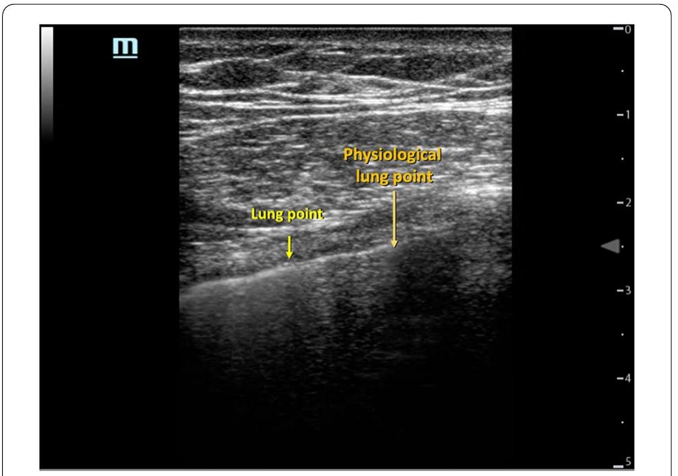 Lung point sign and mediastinal point sign (video 08)