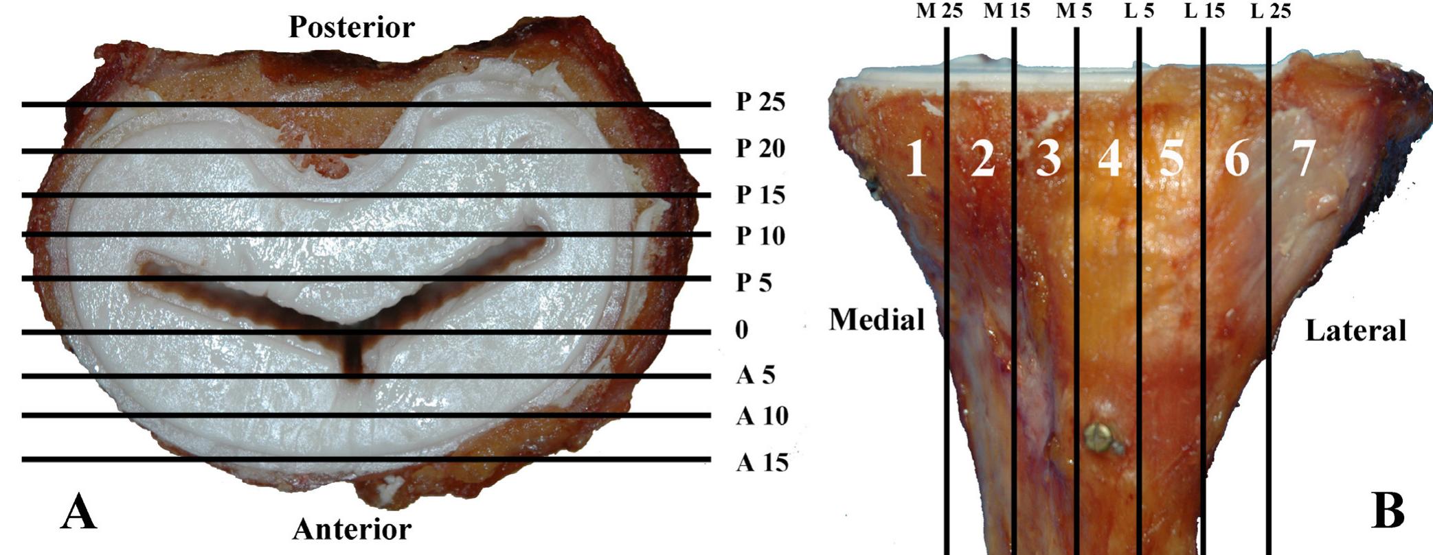 Example of the proximal tibia showing the levels of