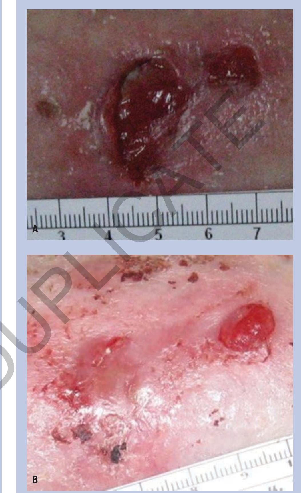 (a) patient no. 1, wound no. 2: a venous ulcer on the