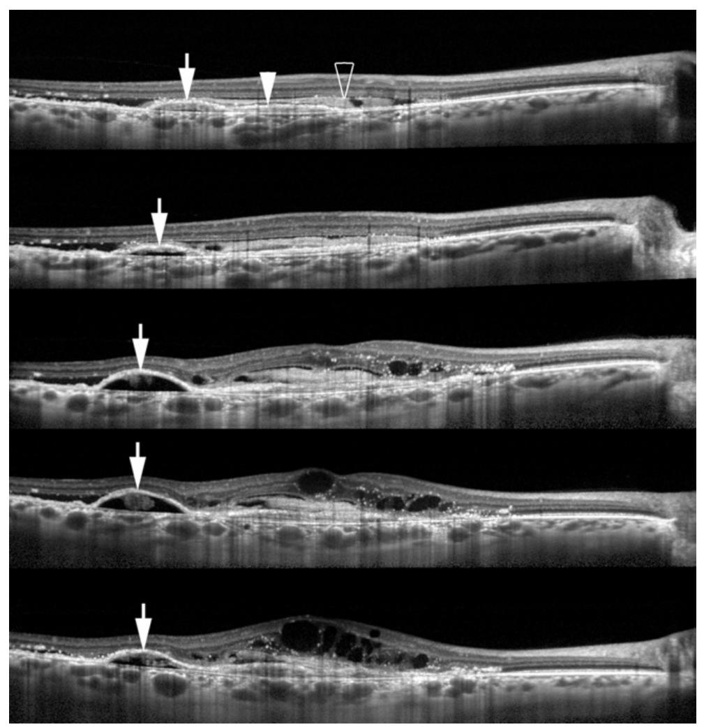 Enhanced depth imaging optical coherence tomog- raphy (edi