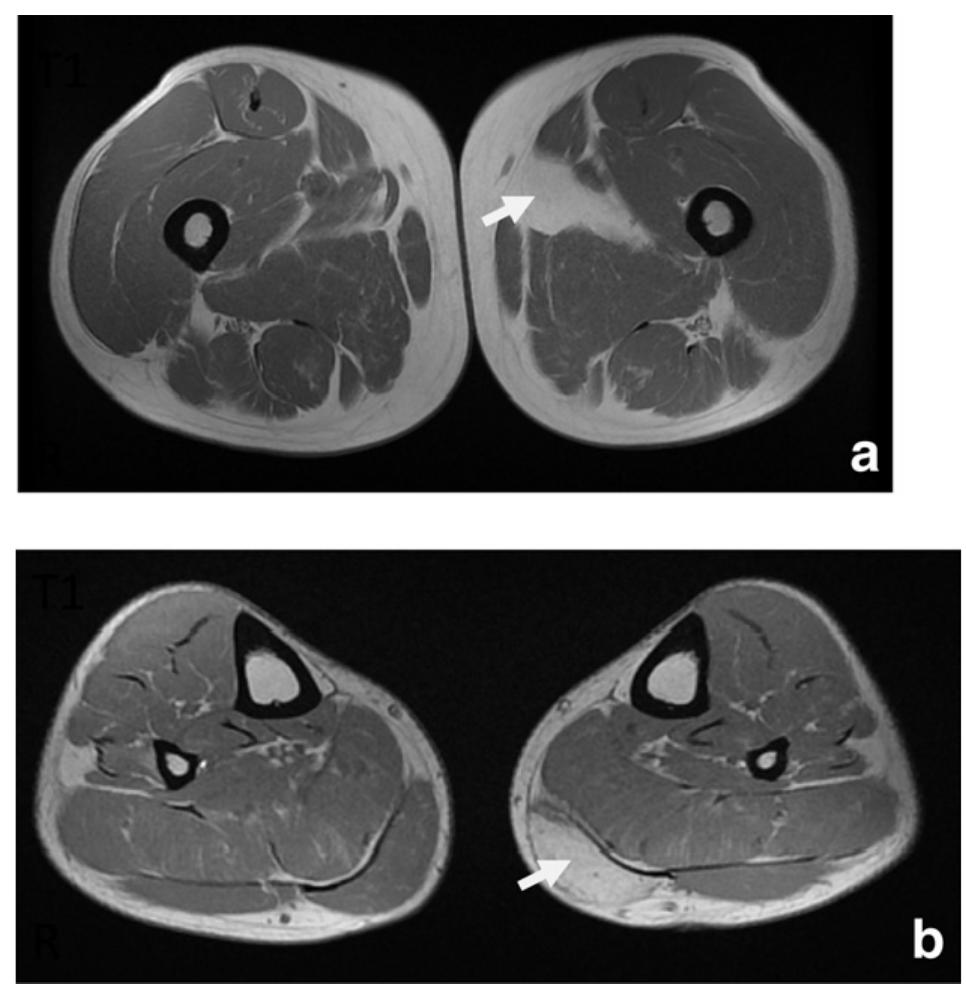 Tl-weighted skeletal muscle mri of the lower limbs: (a) at