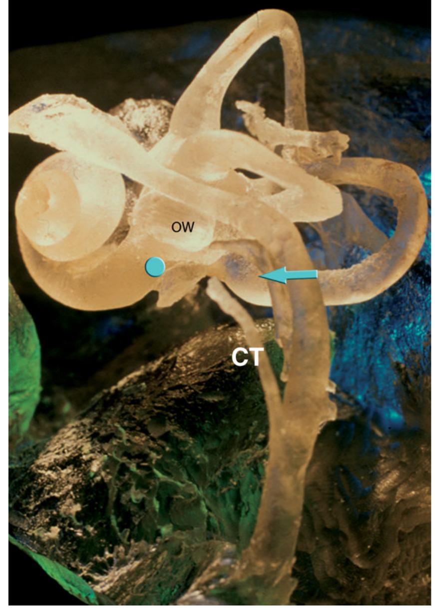 Surgical anatomy of the facial recess. plastic mold of a