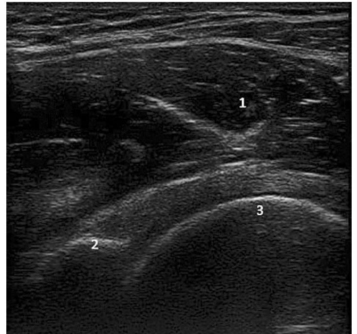 Transverse oblique image of normal an- terior hip joint:
