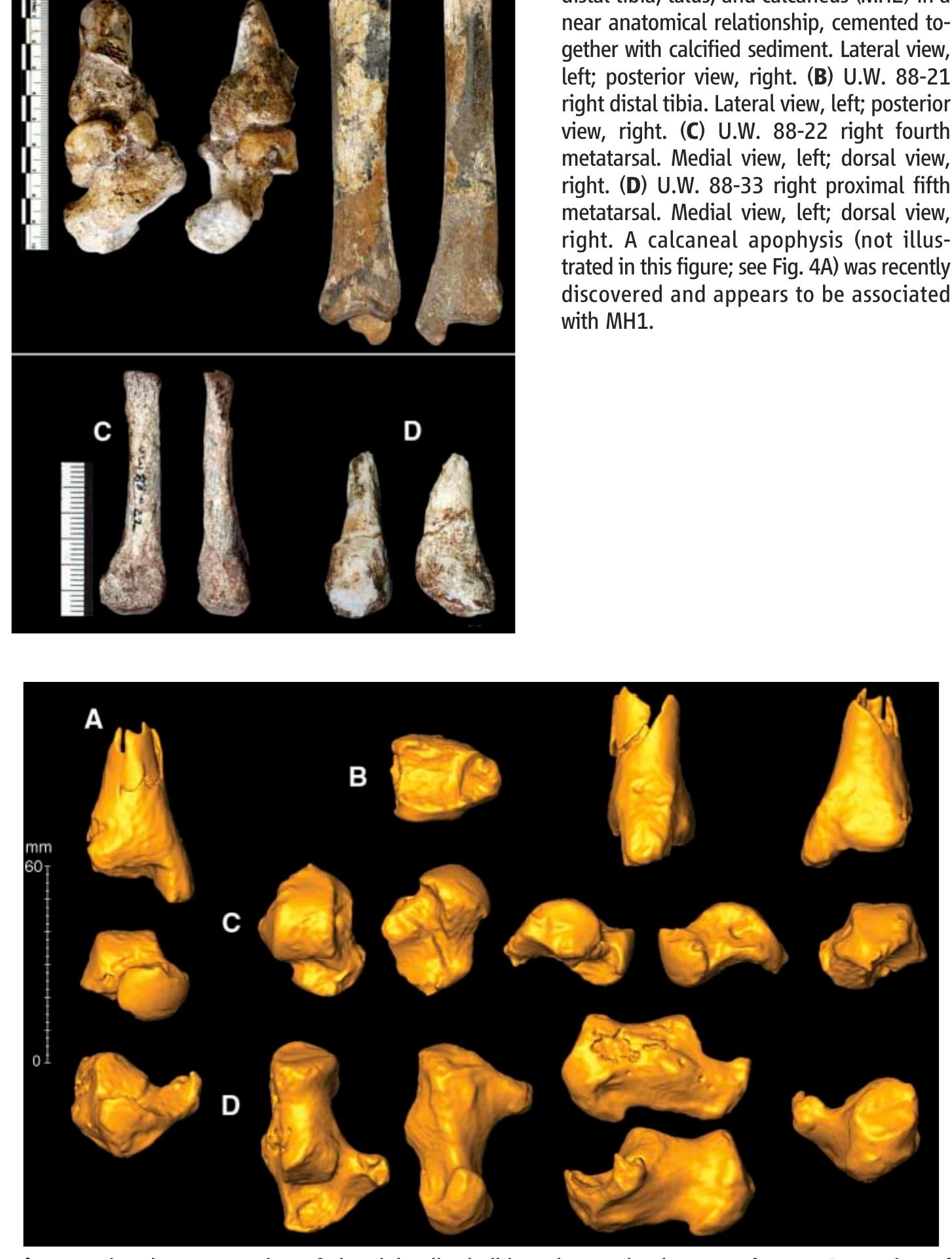 Virtual reconstruction of the right distal tibia, talus, and