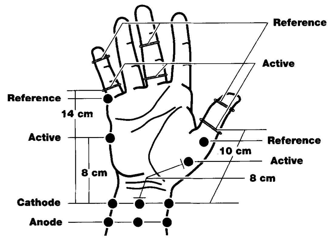 —distal nerve conduction study techniques. ulnar and median