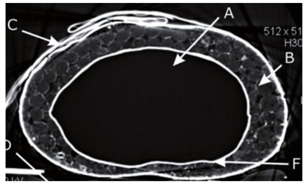 Ct scan, cross section through the abdomen; the inner hollow