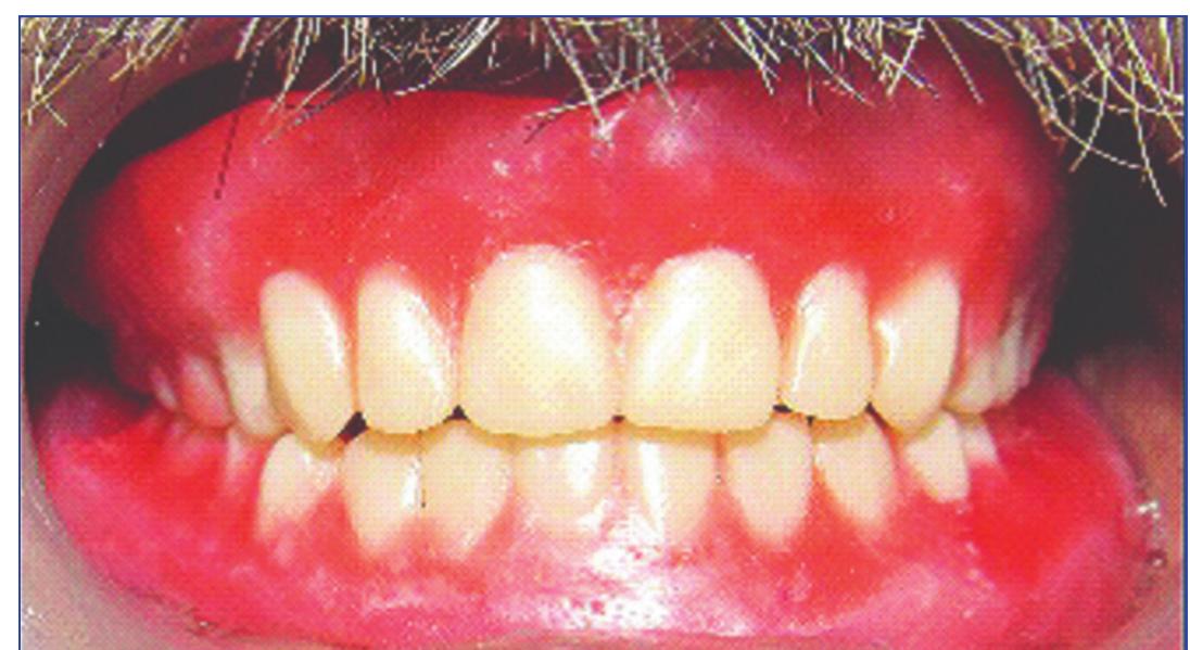 [table/fig-8]: anterior teeth try-in.