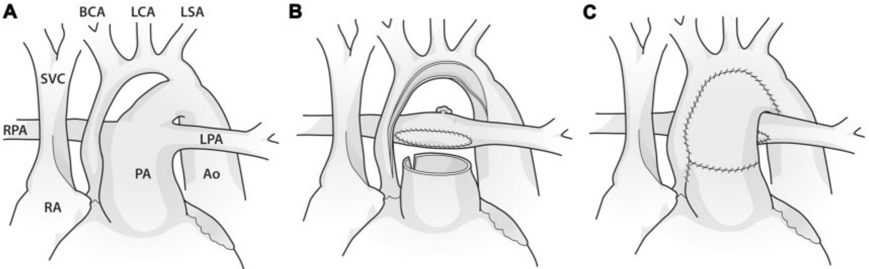 (a-c) classical aortic arch reconstruction technique for