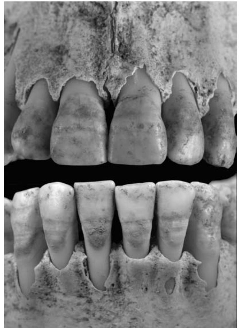 Enamel hypoplasia on the maxillary and mandibular anterior