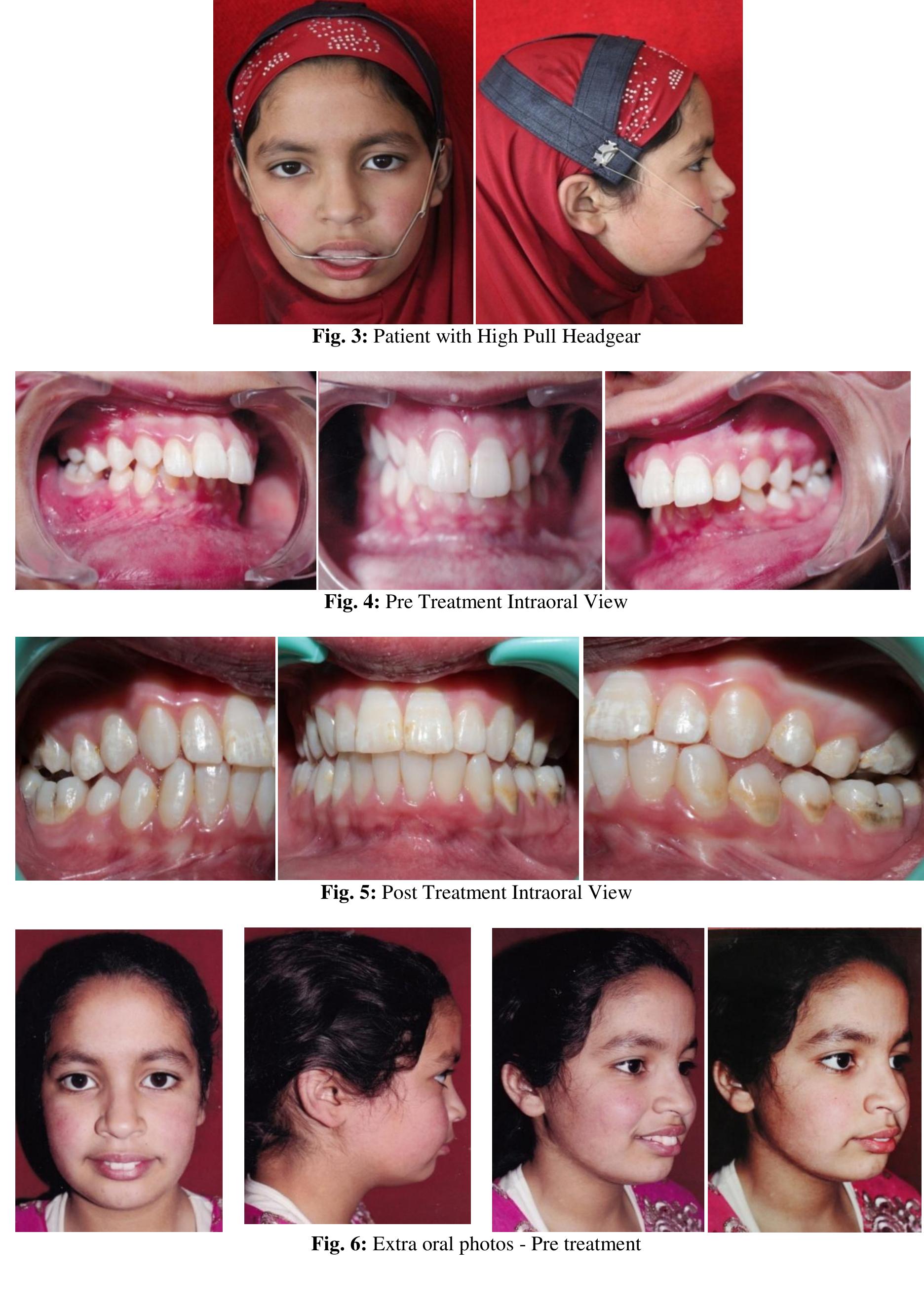 Figure 4 - from Maxillary Growth Control with High Pull