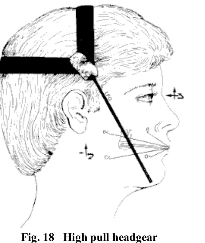 Figure 14 - from MOLAR DISTALIZATION