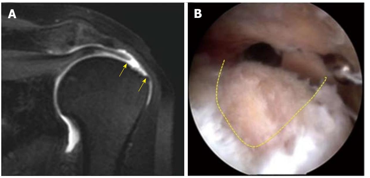 Magnetic resonance arthrography of a c2 lesion of the