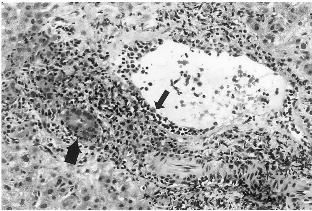 Figure 1 - Banff schema for grading liver allograft