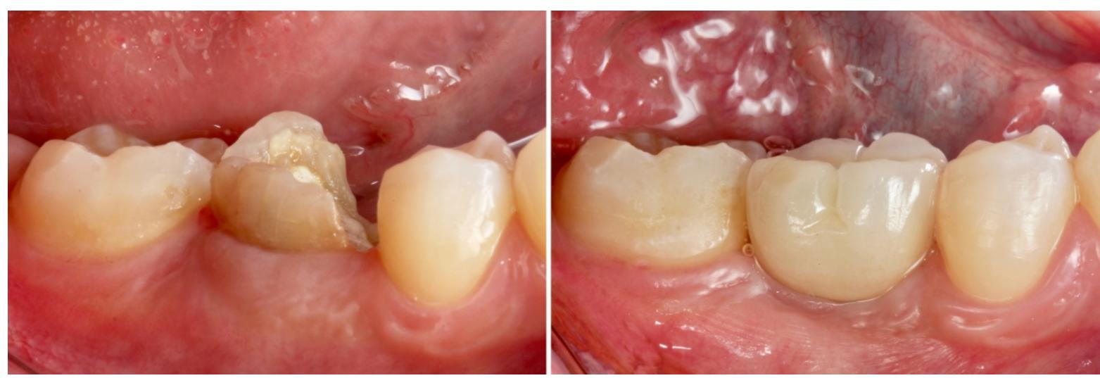 Left: fracture and extrusion of mandibular first molar.