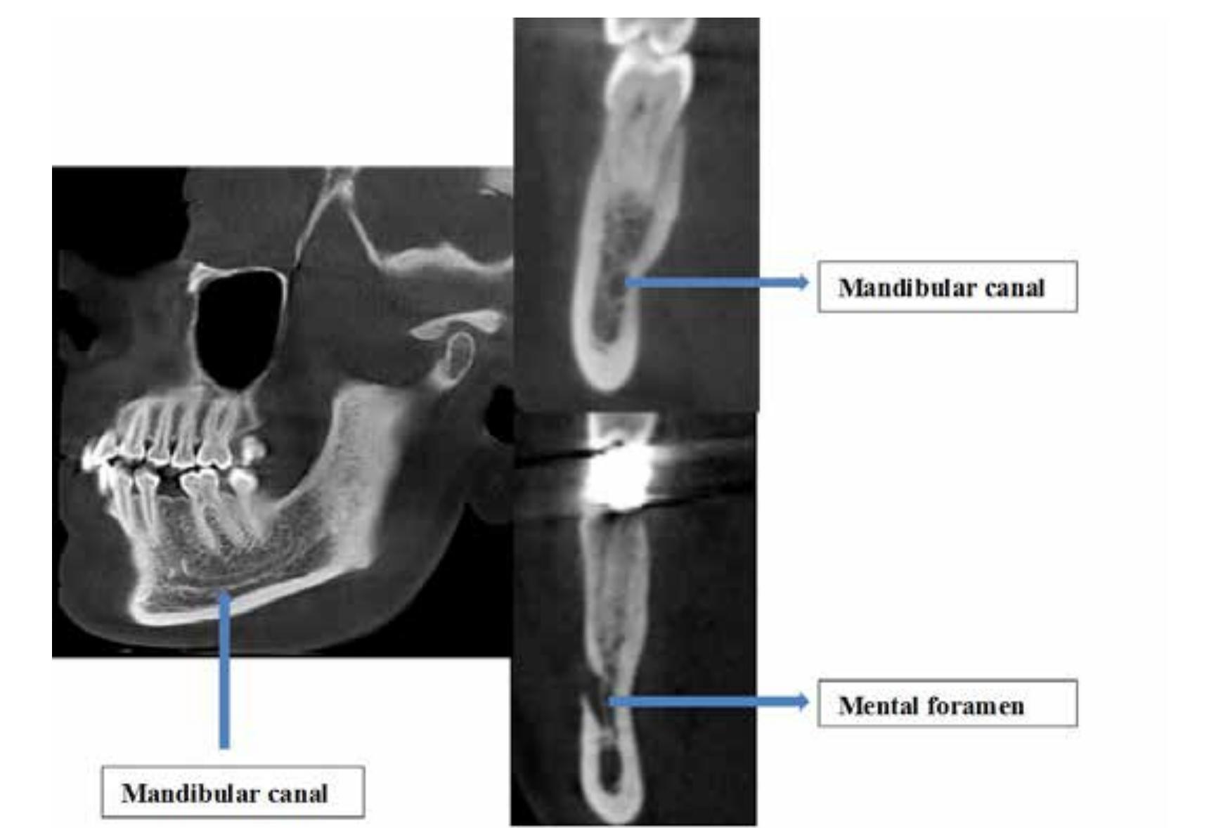 The mandibular canal, mental foramen are seen on sagittal