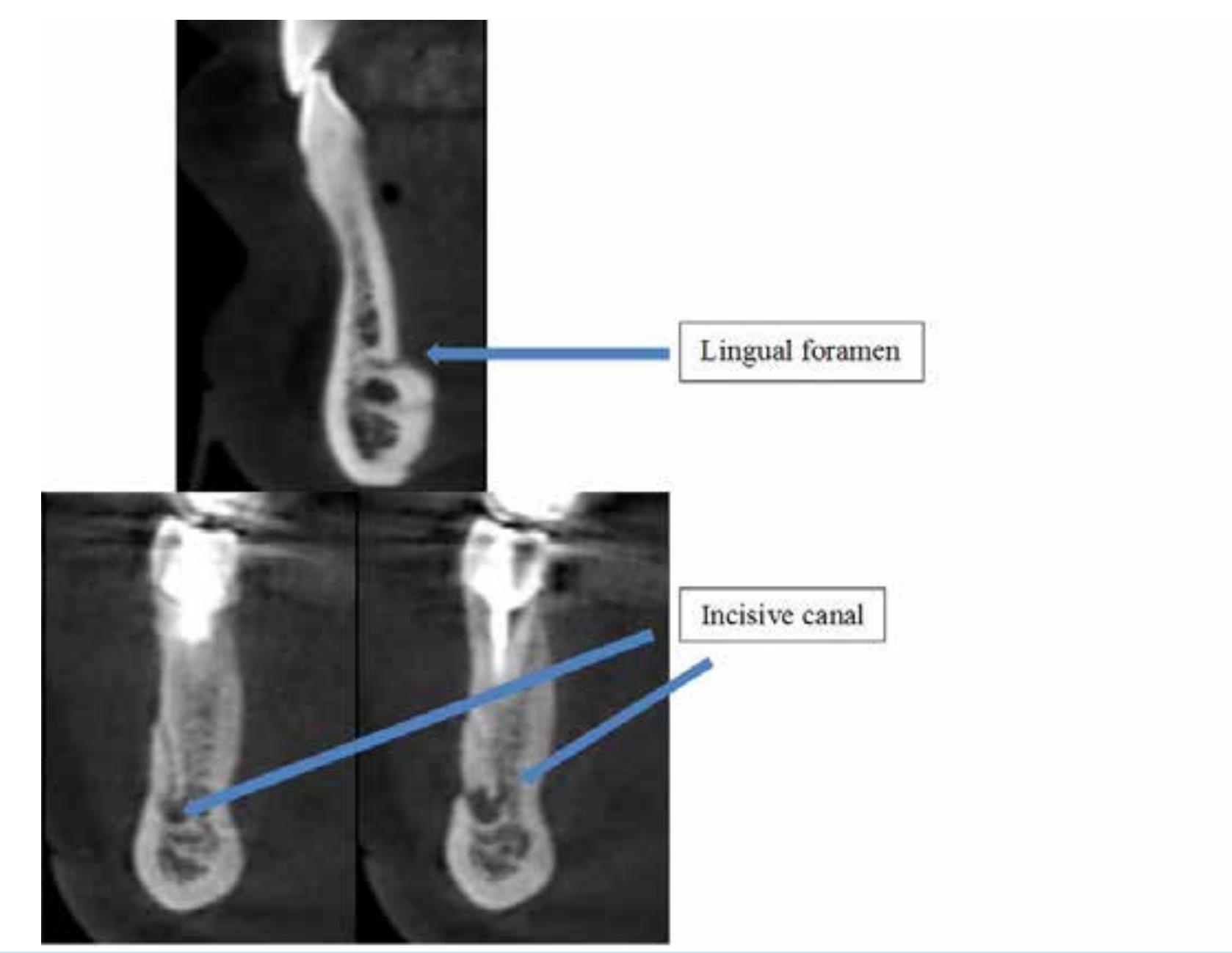 The Lingual Foramen And Mandibular Incisive Canal Are Seen