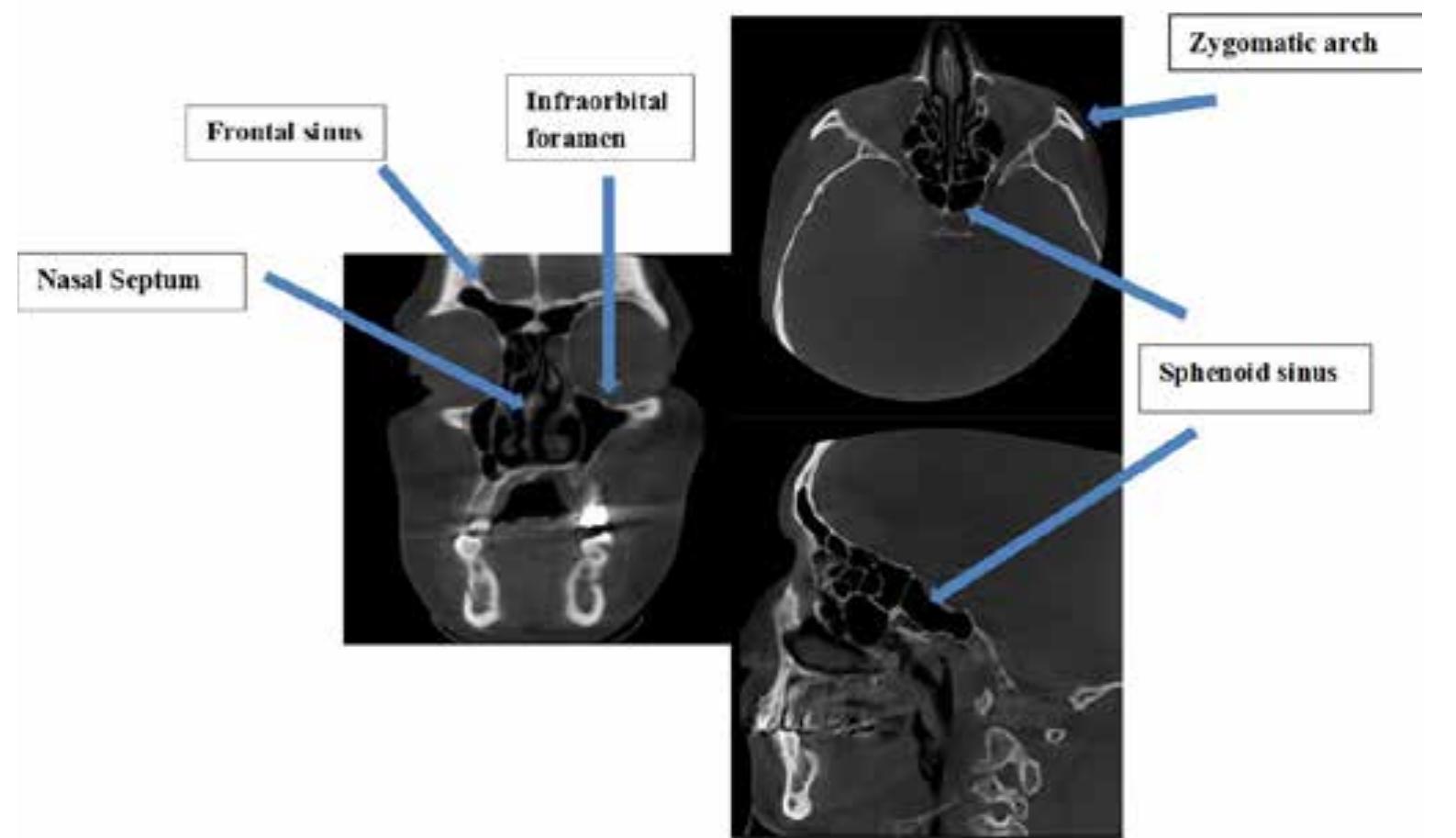 The maxillary, frontal, sphenoid sinuses, nasal septum and