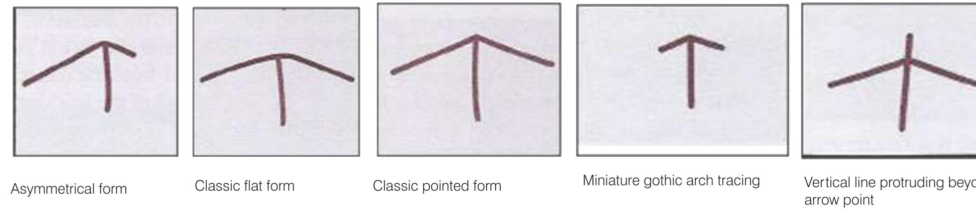 (PDF) An insight into gothic arch tracing
