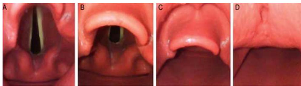 On direct laryngoscopy glottis view was classified according