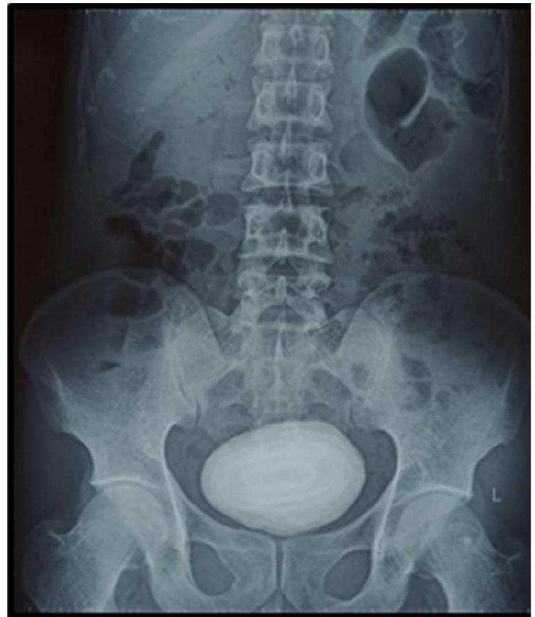 Plain x-ray shows a radiopaqueshadow, well defined,