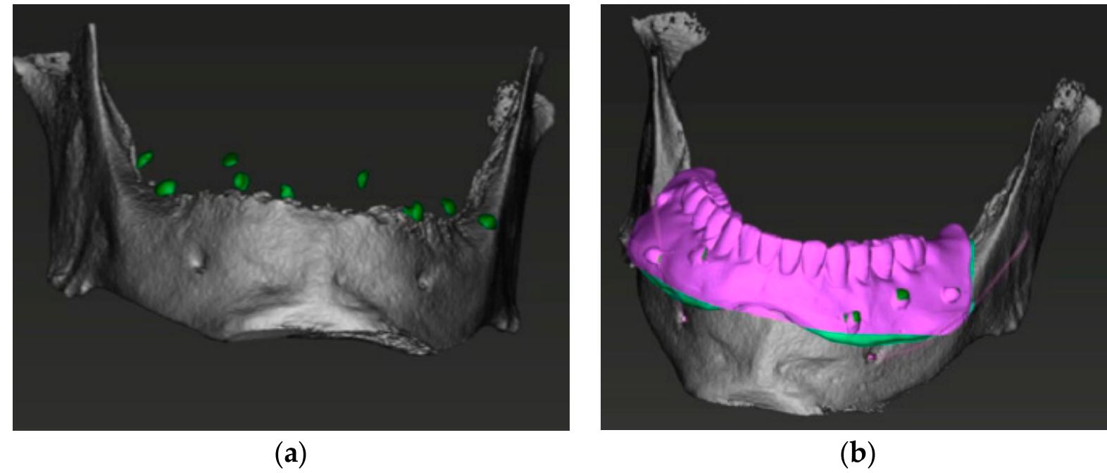 (a) 3d mandibular reconstruction from dicom file; (b)