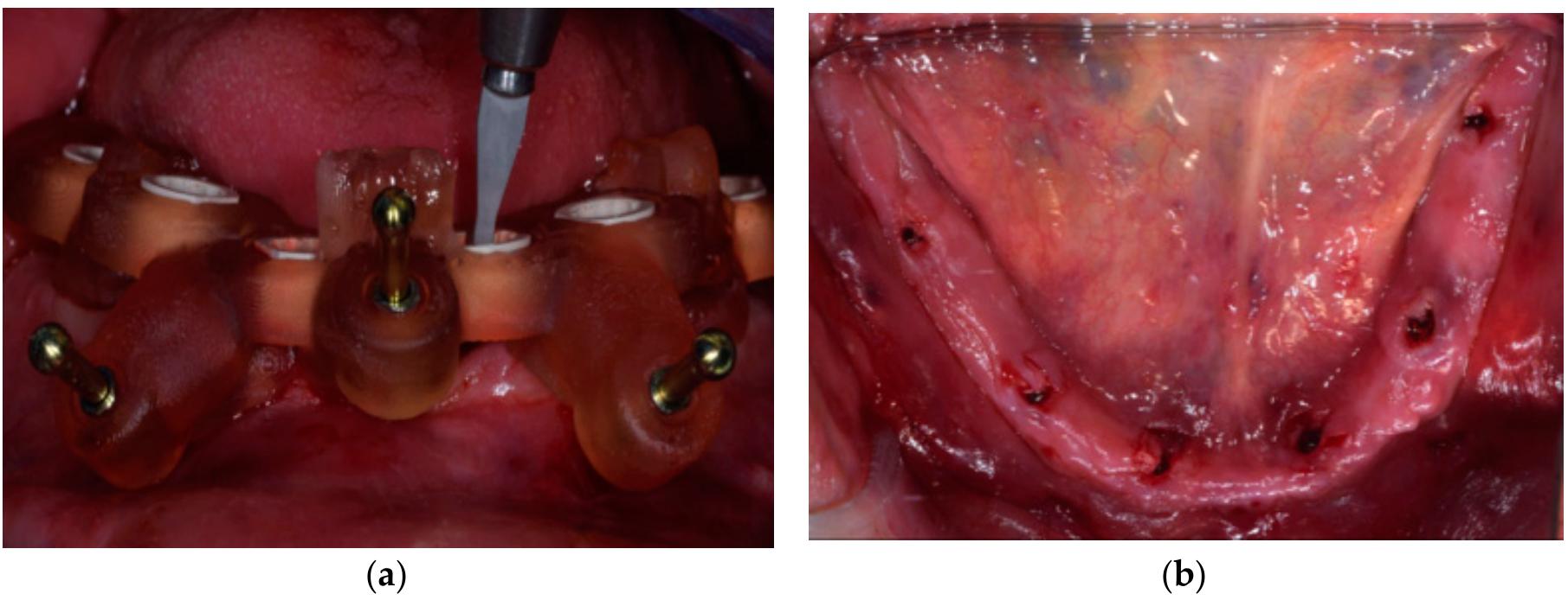 (a) surgical stent in place after the insertion of anchor
