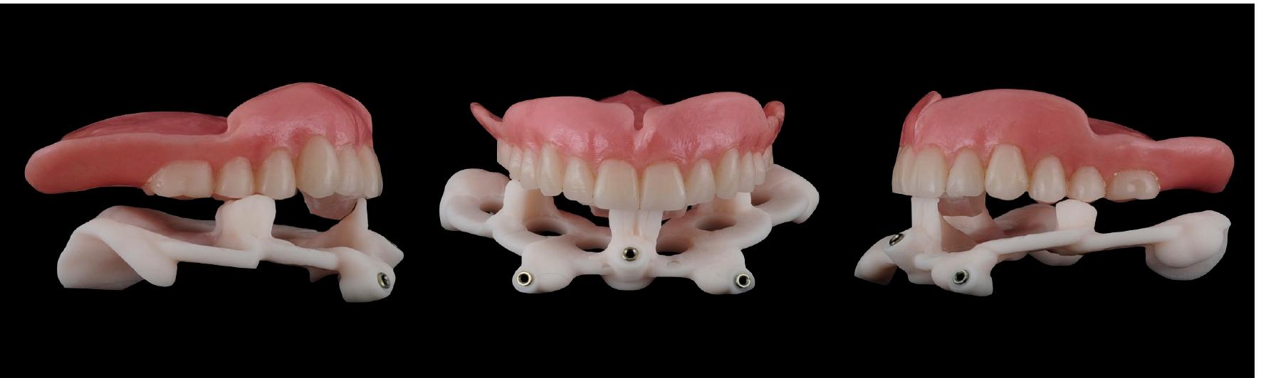 Frontal and lateral views of the prosthetic stent.