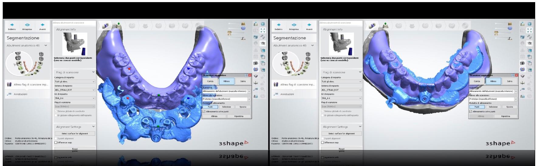Superimposition of the original prosthetic project and of