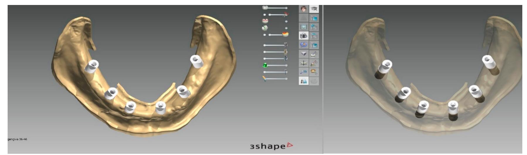Mandibular model with scan bodies at sra abutment level in