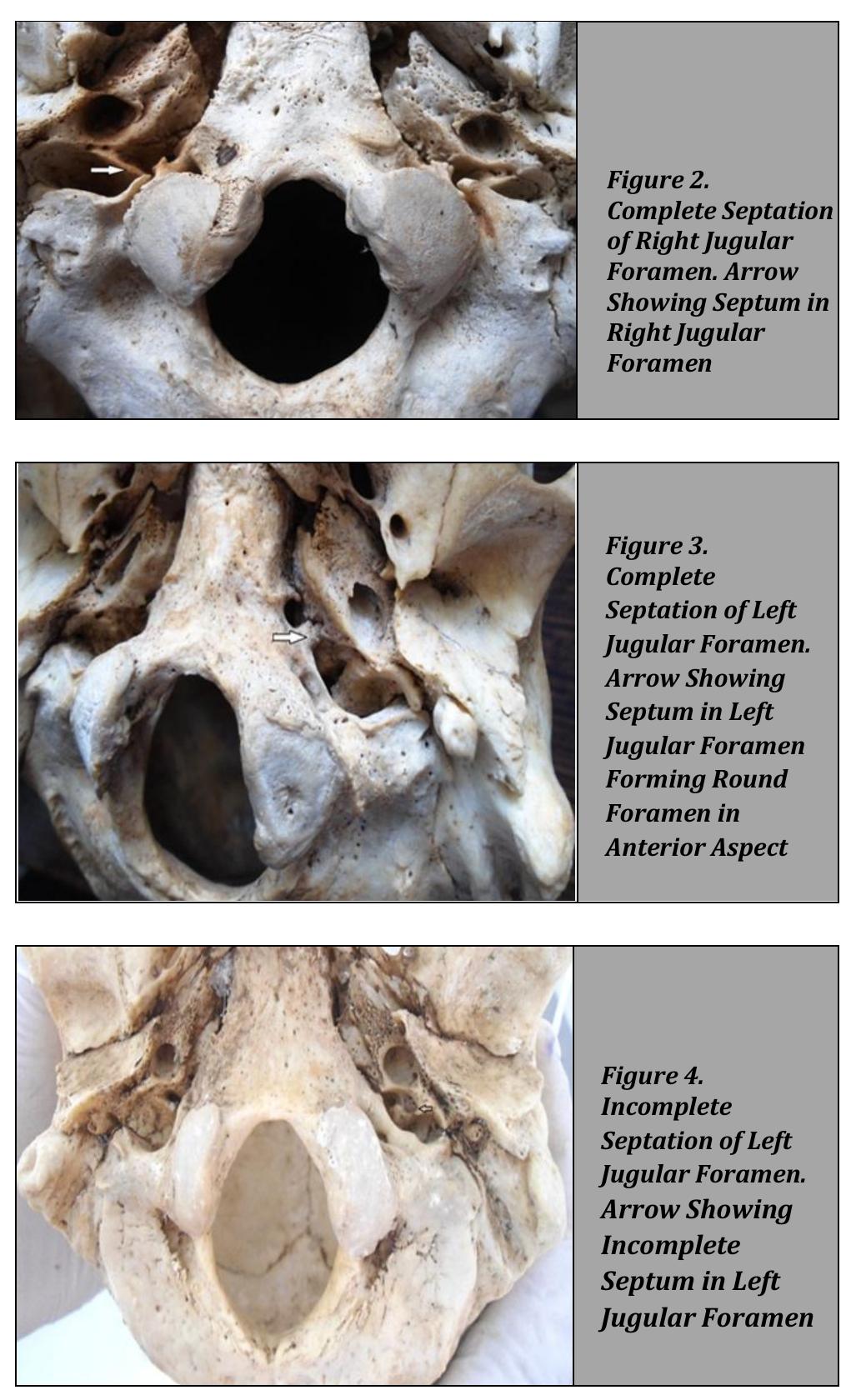 Figure 2 - Morphometric Aspects of the Jugular Foramen and