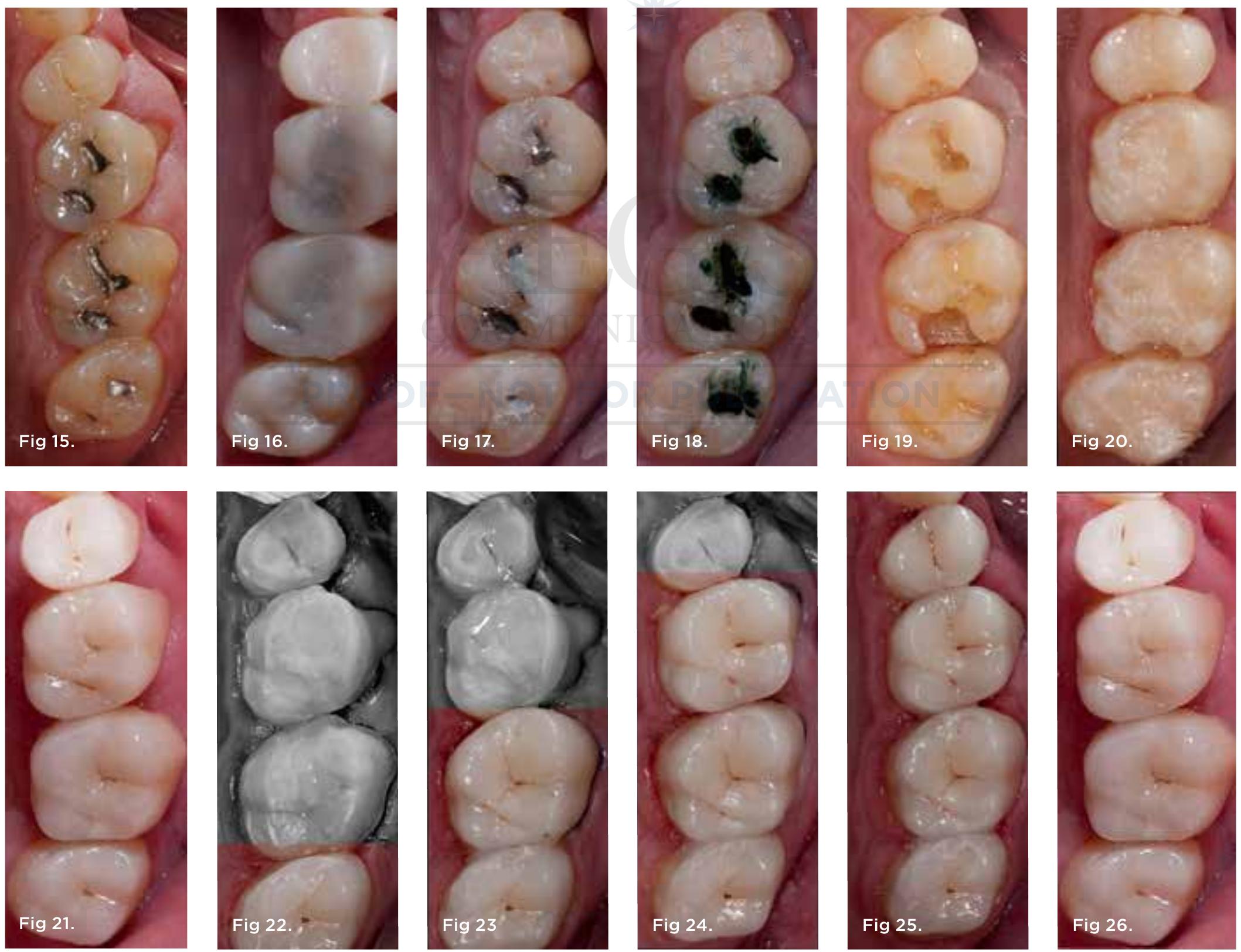 (PDF) Vonlays: a conservative esthetic alternative to full-coverage crowns