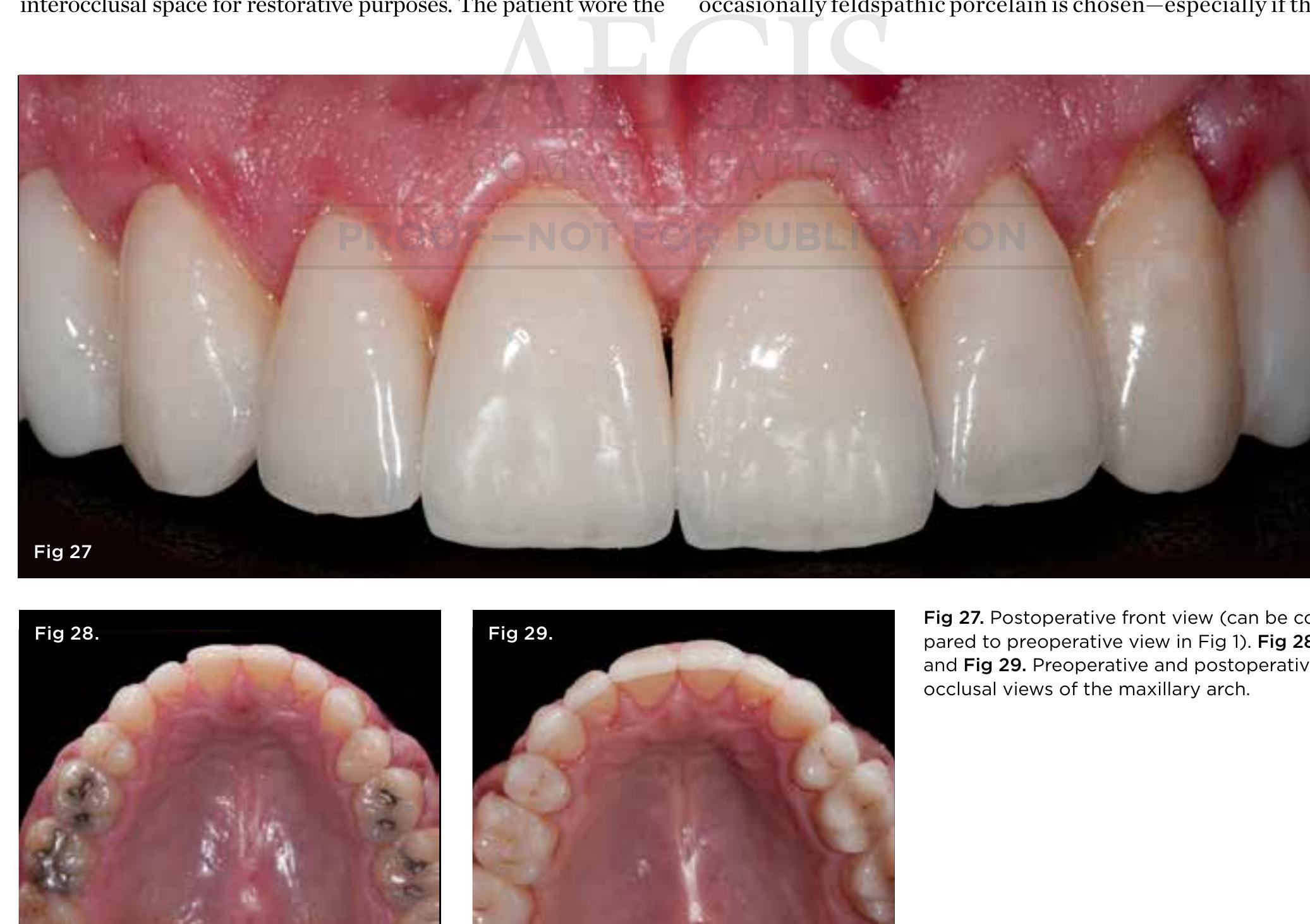 (PDF) Vonlays: a conservative esthetic alternative to full-coverage crowns
