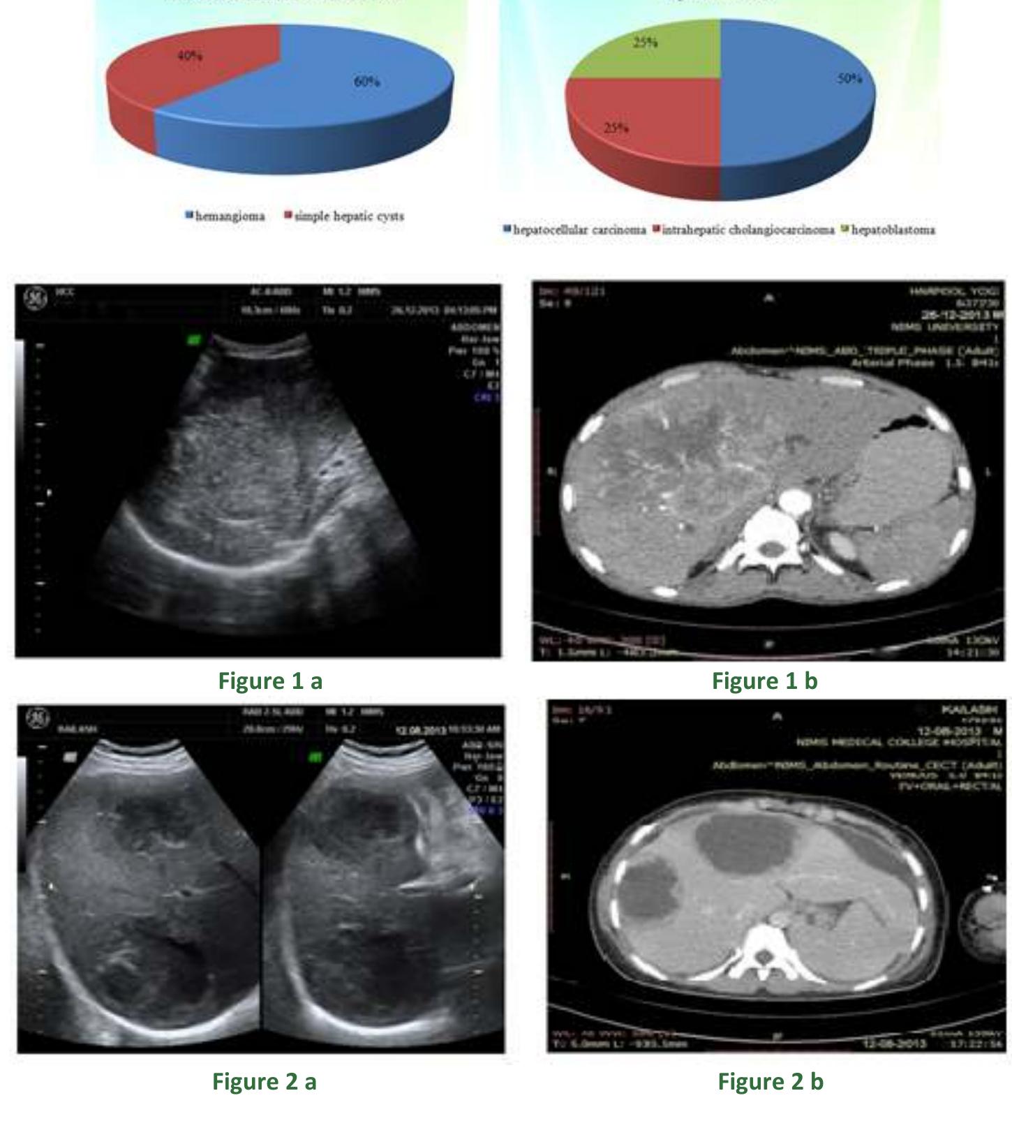 Hepatocellular carcinoma was more easily identified and