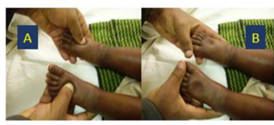A) bilateral edema and b) indication of edema. edema: edema