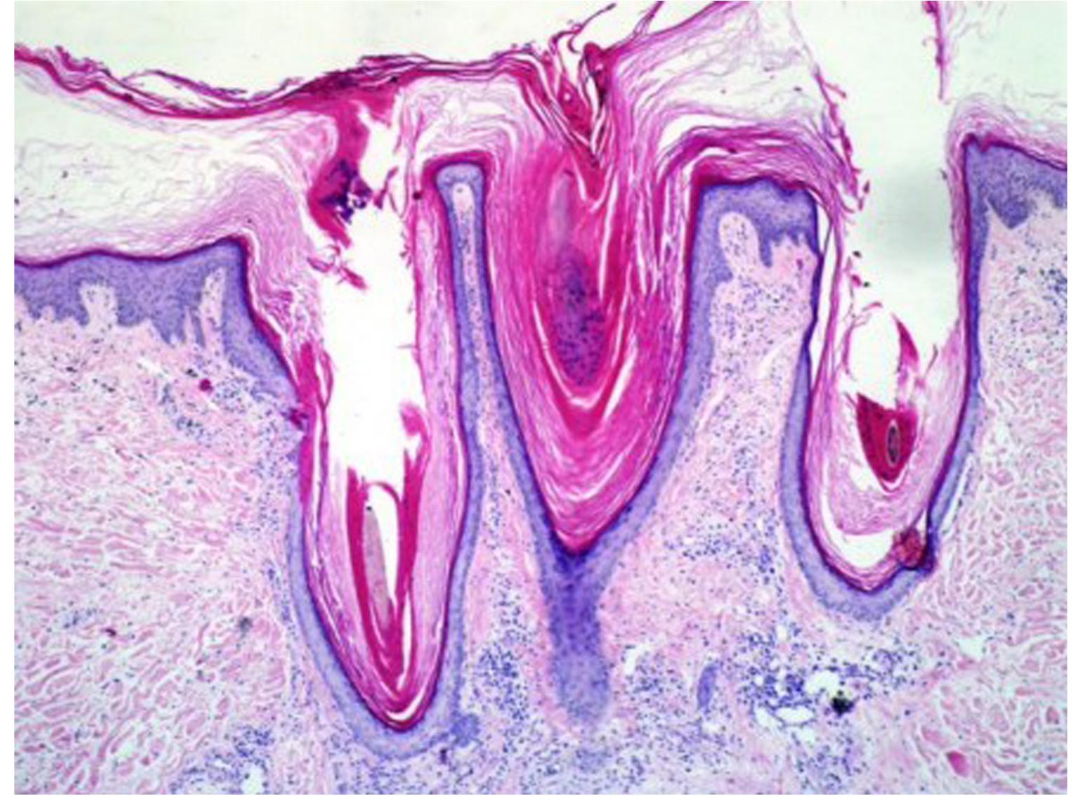 Figure 2 - from Essential fatty acid deficiency while a