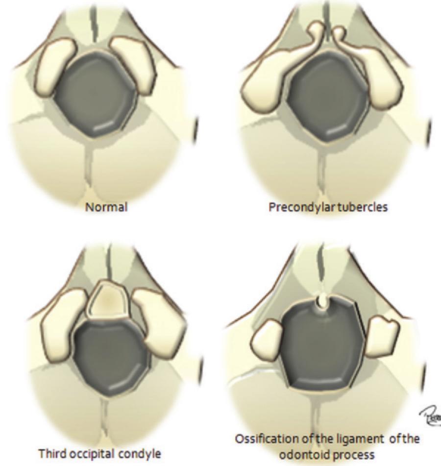Figure 1 - from Imaging of Atlanto-Occipital and