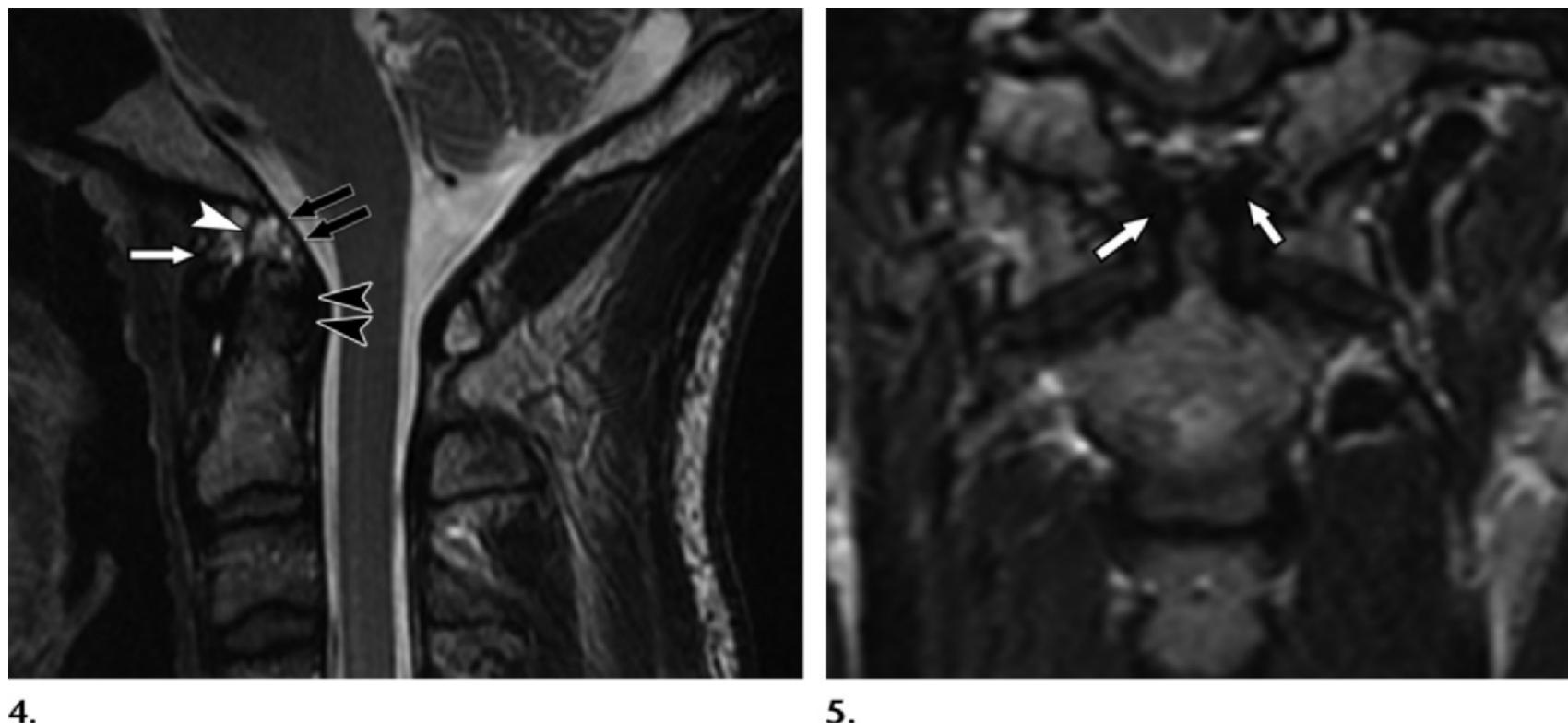 S 4, 5. (4) cc) ligaments. sagittal t2-weighted mr image of