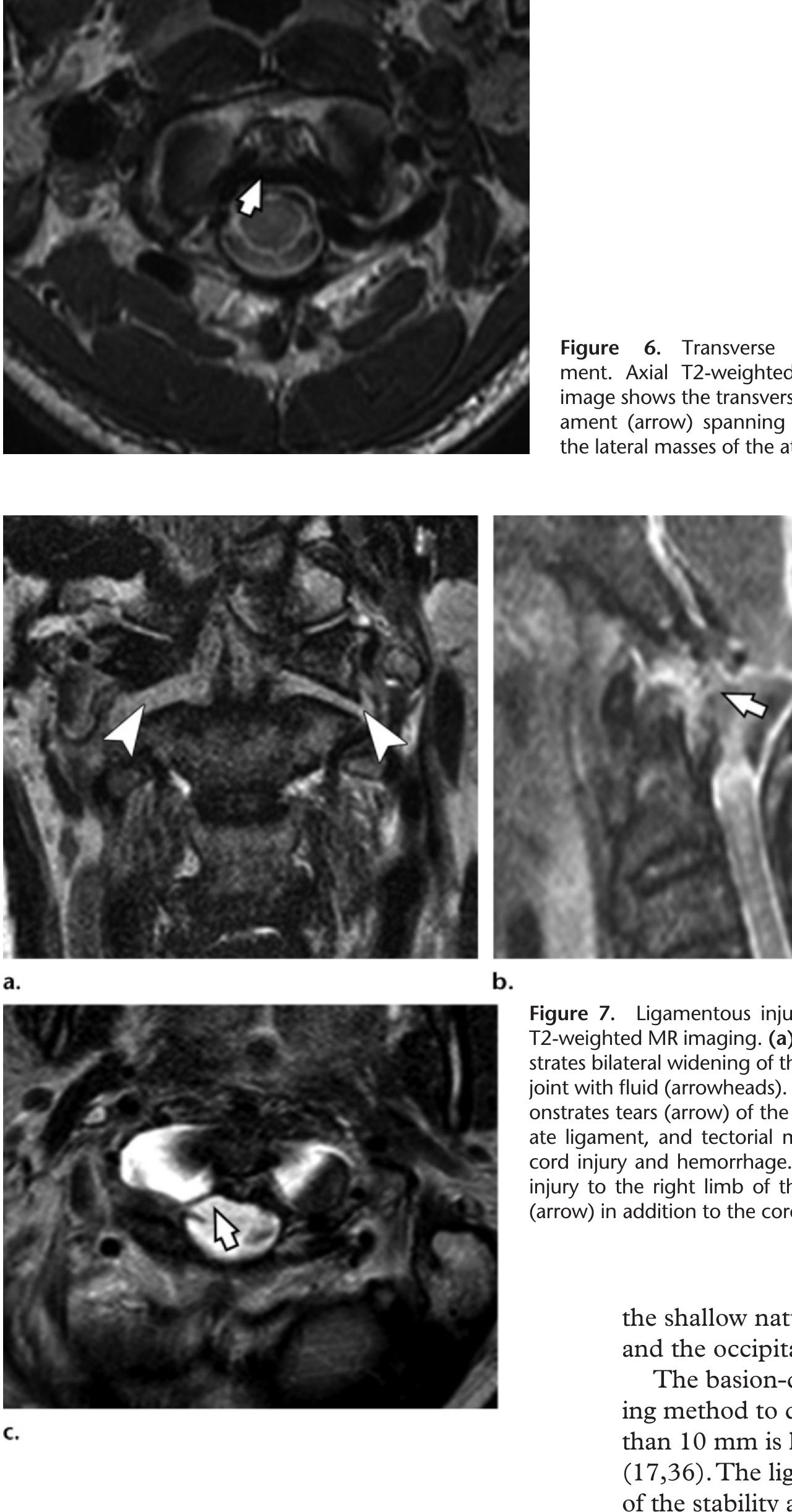 (PDF) Imaging of Atlanto-Occipital and Atlantoaxial Traumatic Injuries ...