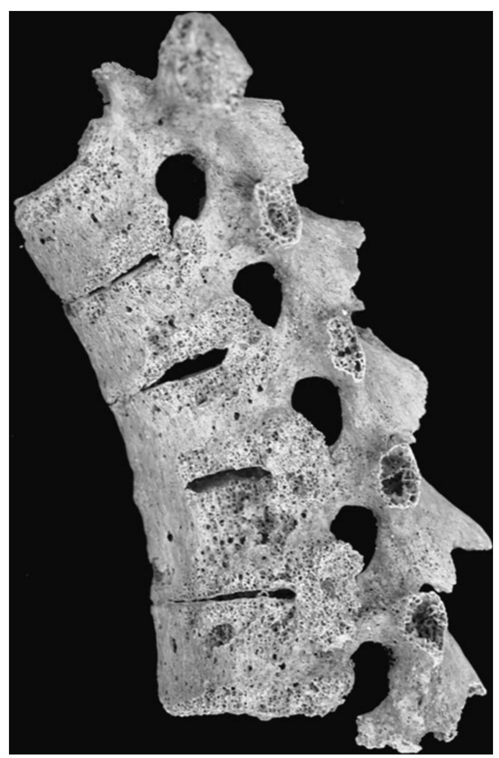 Lateral view (left side) of fused lumbar vertebrae of the
