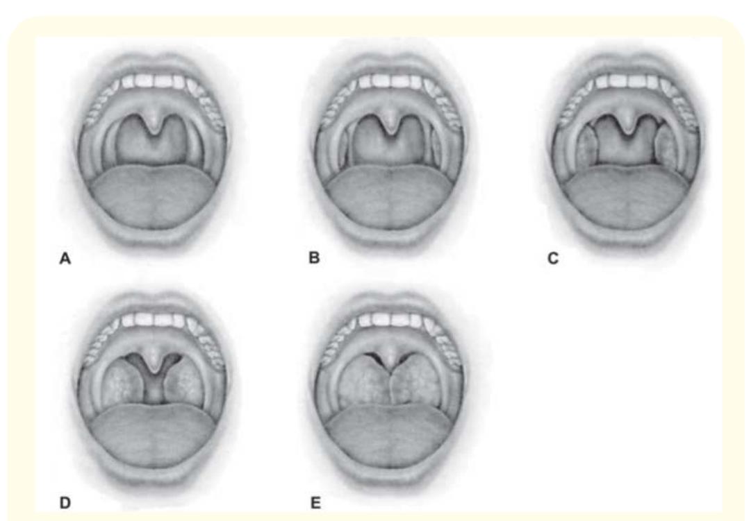 Illustration of tonsil grades. a. ts 0: status post