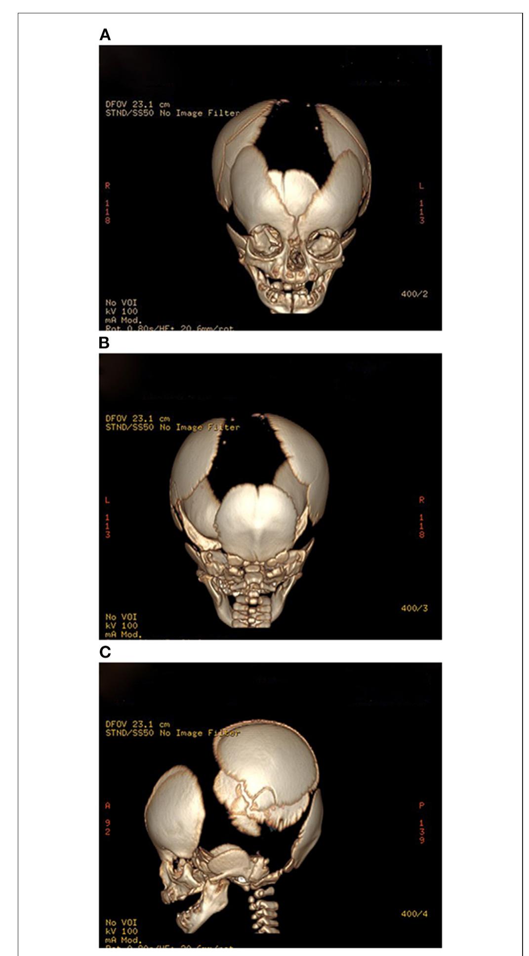| (a-c) propositus skull ct, frontal, posterior, and lateral