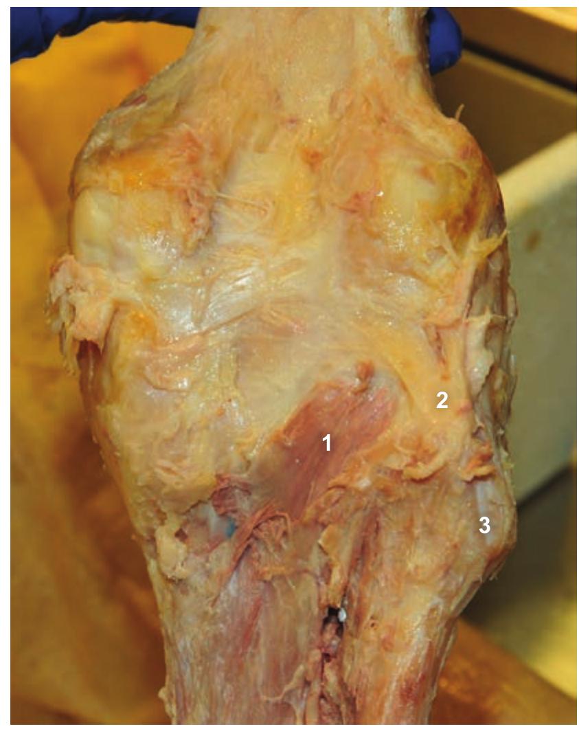 Posterior knee dissection. right knee, posterior view. 1,