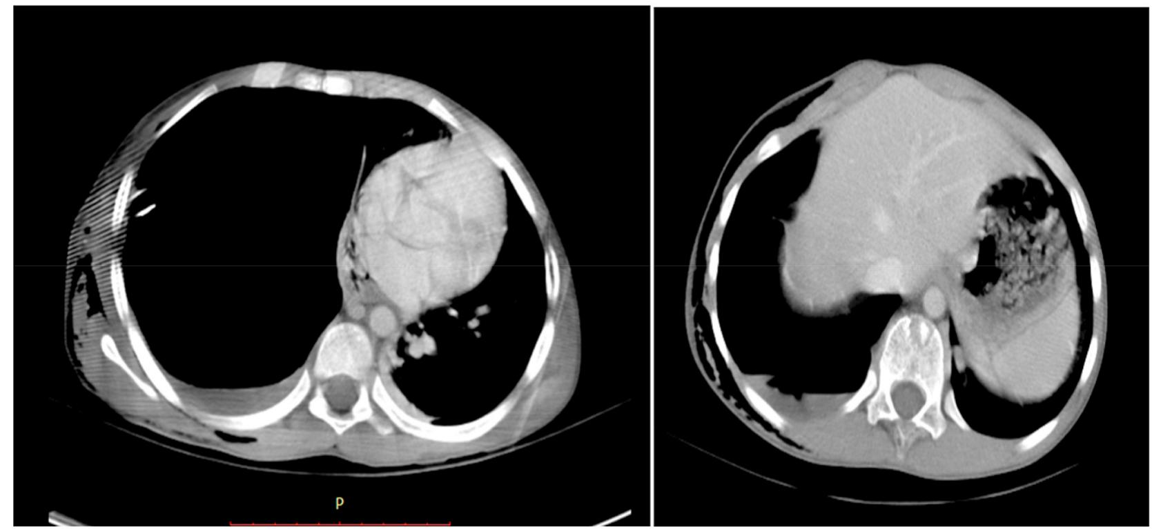 Ct scan of the chest demonstrating right big air filled cyst